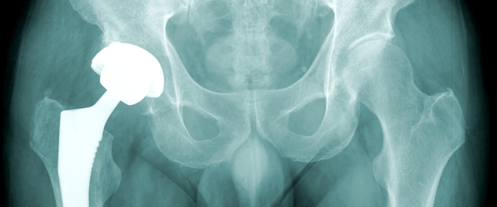Wanneer een heupprothese?